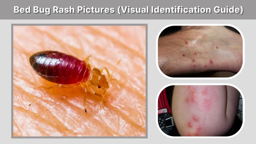Bed Bug Rash Symptoms Pictures Causes And Treatment