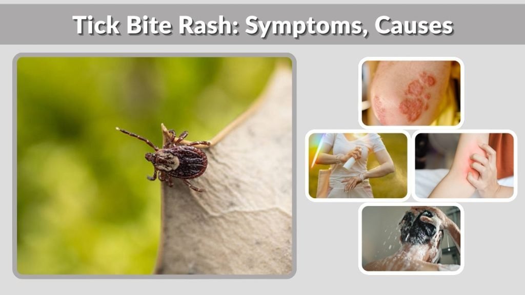 Tick Bite Rash: Symptoms, Causes, and When to Worry